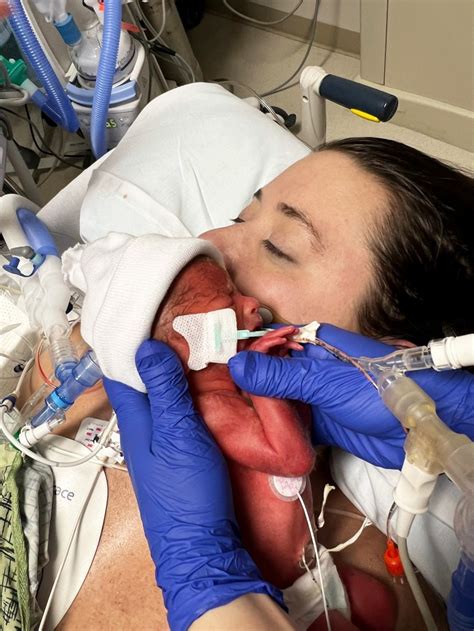 Pregnant Womans Strep Infection Worsens Leads To Amputation