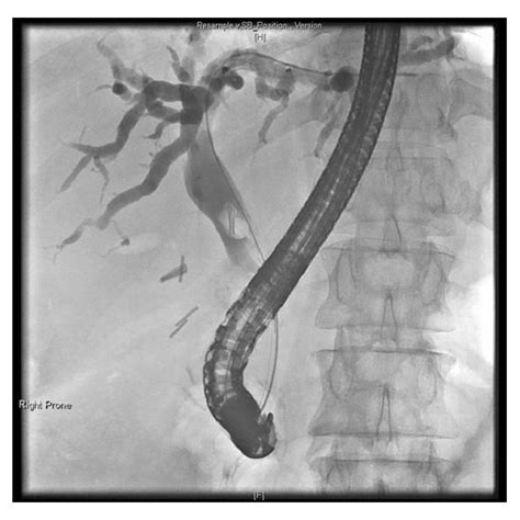 Pdf Acute Cholangitis Following Intraductal Migration Of Surgical Clips 10 Years After