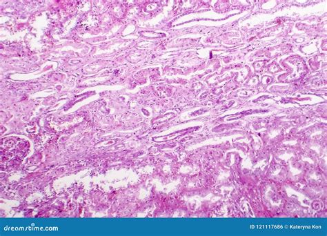 Tubular Epithelial Edema Royalty Free Stock Image