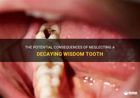 The Potential Consequences Of Neglecting A Decaying Wisdom Tooth Medshun