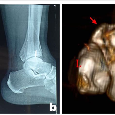 A 36 Year Old Male Patient With Pilon Fracture Of The Right Tibia