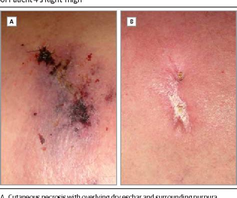 Subcutaneous Calcification Semantic Scholar