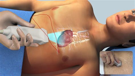 Focused Cardiac Ultrasound For The Nephrologist The Subxiphoid View Renal Fellow Network