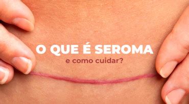 Seroma O Que é E Como Cuidar Dr Daniel Rufatto