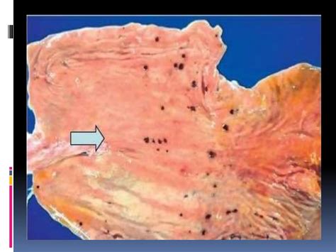 Pathology Of Peptic Ulcer Pptx