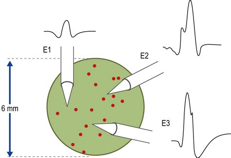 Basic Electromyography Analysis Of Motor Unit Action Potentials Clinical Tree