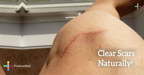 Clear Scars Naturally Positivemed