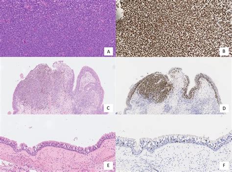 Immunohistochemical Staining Of The Index Patient A Hande Stain Of