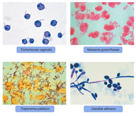 Trichomonas Vaginalis Gram Stain