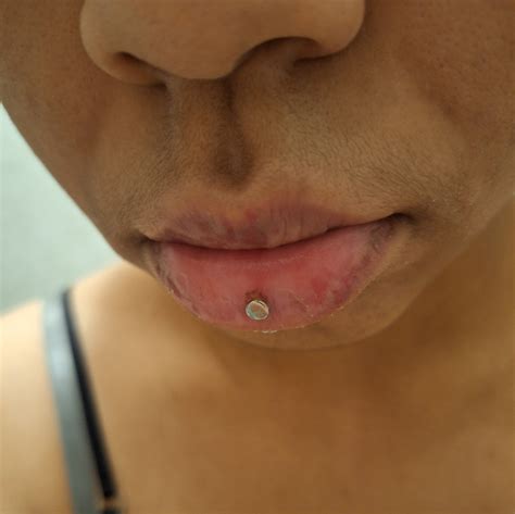 Infection Du Labret Vertical Infection Du Labret Vertical