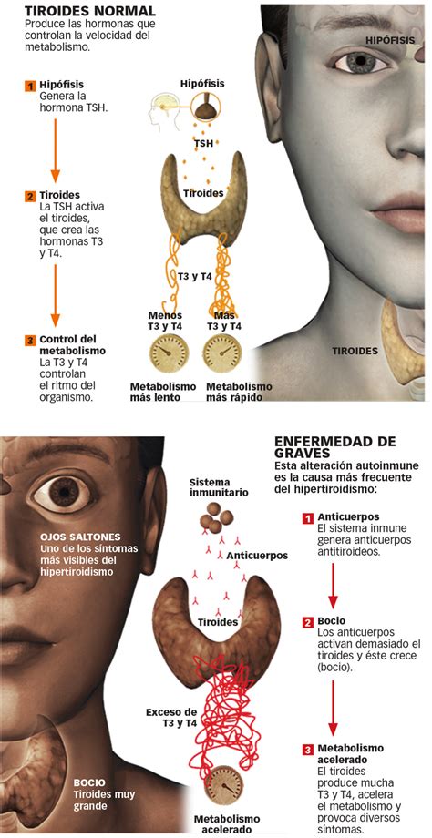 Sintomas De Hipotiroidismo