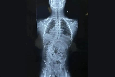 脊柱侧弯60度外观图片