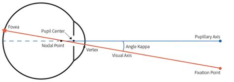 강남지에스안과의원 Gs안과 스마일프로 스마일라식 렌즈삽입술