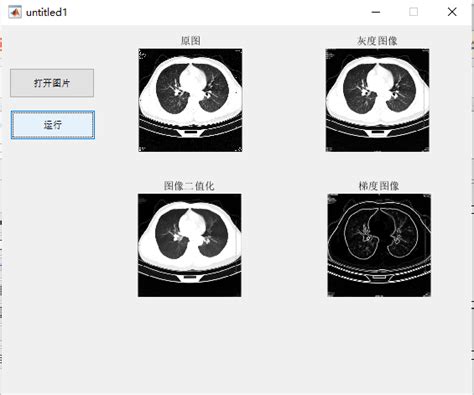 【matlab】基于分水岭分割进行肺癌诊断gui设计 基于matlab肺癌细胞检测 csdn博客
