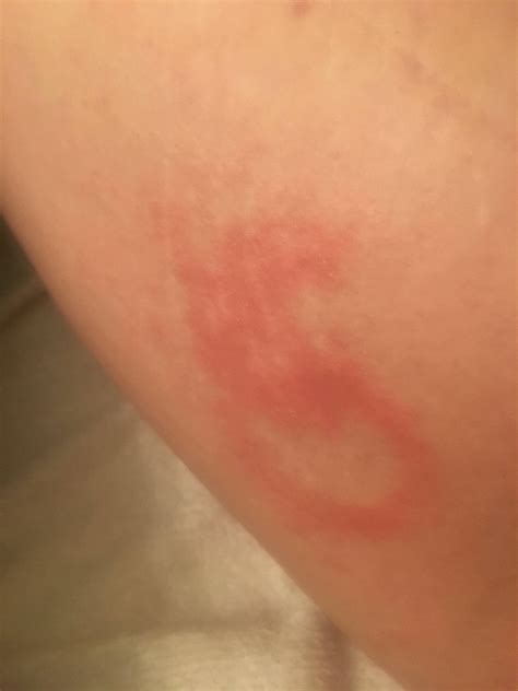 Accutane Rash Halp Rskincareaddiction