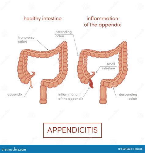 Appendicitis Inflammation Of The Appendix Colon The Illustration On