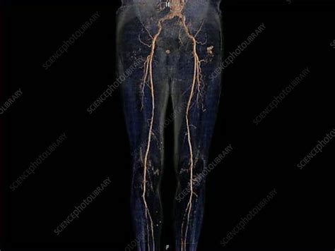 Leg Arteries Angiogram Stock Video Clip K0025534 Science Photo