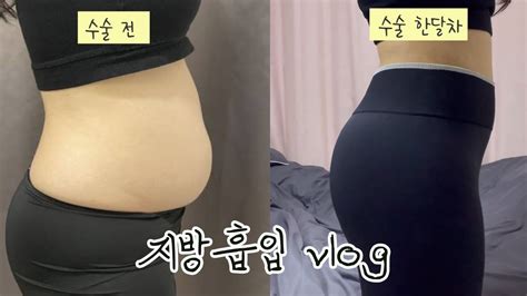 지방흡입 Vlog 지방흡입 한달차 리얼 후기 Youtube