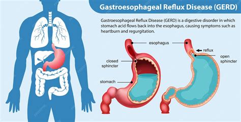 Diagramme Rgo De La Maladie De Reflux Gastro Oesophagien Vecteur Gratuite