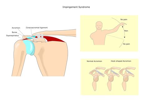 What Is Shoulder Impingement Syndrome Signs Symptoms And Treatments