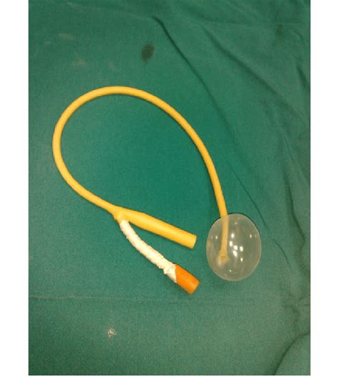 Modified Foleys Catheter Trimmed Distal End And Wrapped Secondary