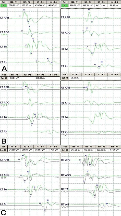 Figure 1 From The Utility Of Bispectral Index Monitoring In Management