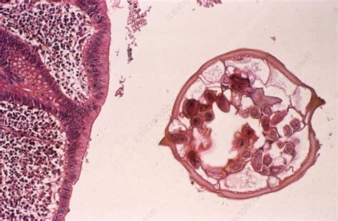 Pinworm Infection Of The Appendix Stock Image C022 7218 Science Photo Library
