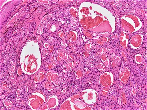 Spindle Cell Hemangioma Libre Pathology At Sandra Steele Blog