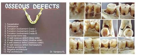 Pdf Periodontal Osseous Defects A Review