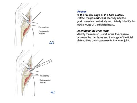 Proximal Tibia Approach Pptx