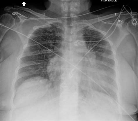 257lu Carcinoid And Lingula Atelectasis The Common Vein