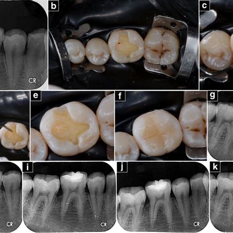 Complete Treatment Sequence Of Biodentine Direct Pulp Capping A Download Scientific Diagram