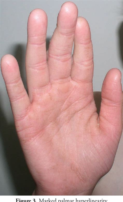 [pdf] Hypohidrotic Ectodermal Dysplasia A Case Report Hipohidrotska