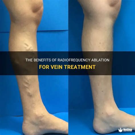 The Benefits Of Radiofrequency Ablation For Vein Treatment Medshun