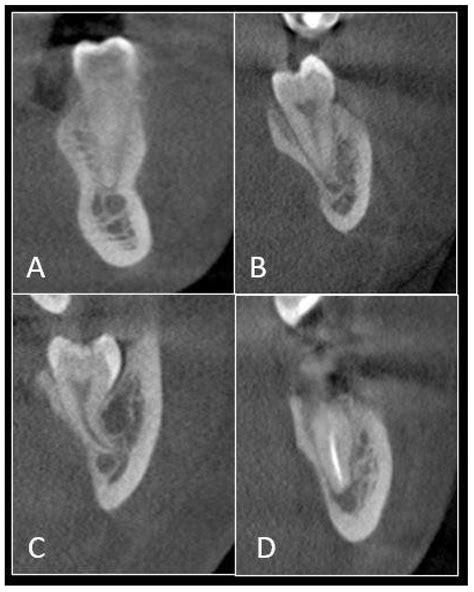 Inferior Alveolar Canal Ct