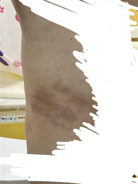 Diagnosed With Plaque Morphea R Scleroderma