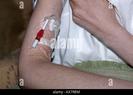 Dressed Picc Line In Arm Of Female Cancer Patient Peripherally Inserted Central Catheter Stock