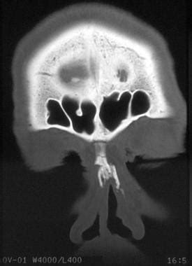 Nasal Fracture Imaging Practice Essentials Radiography Computed