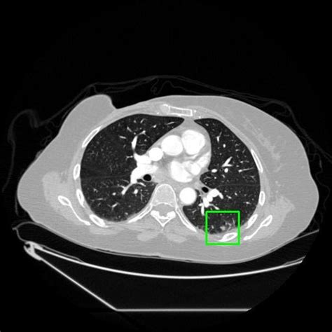 Lung Cancer Detection Object Detection Model By Murad Hassis 1jel5