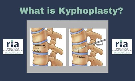 Understanding Kyphoplasty Interventional Radiology Located In Denver And Northern Colorado