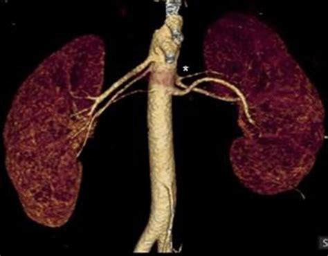 Mdcta Vr Reconstruction Shows Two Hilar Accessory Renal Artery On The