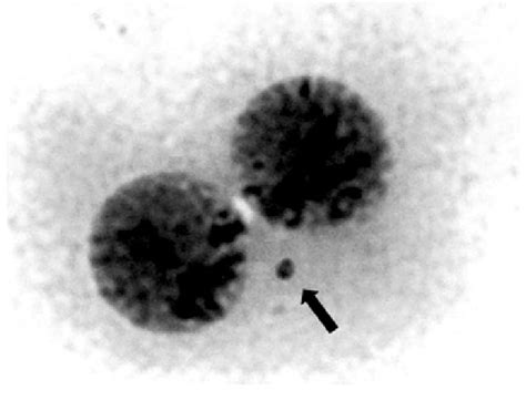 Binucleated Cell With A Micronucleus Marked By An Arrow Download