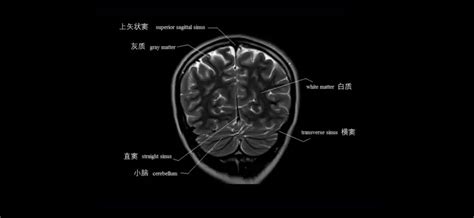 影像解剖：头颅mr冠状面解剖中英文对照 Medsci Cn
