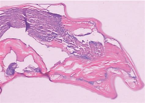 Figure 1 From Hookworm Anemia In A Peritoneal Dialysis Patient In China