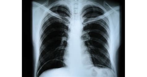 Безплатно преглеждат за туберкулоза в пазарджишката белодробна болница