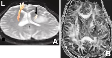 Figure 1 From Proton Magnetic Resonance Spectroscopy And Diffusion