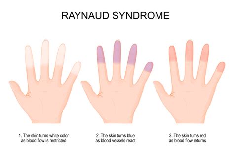 Symptomes Syndrome De Raynaud Syndrome De Raynaud Définition Fmadrg