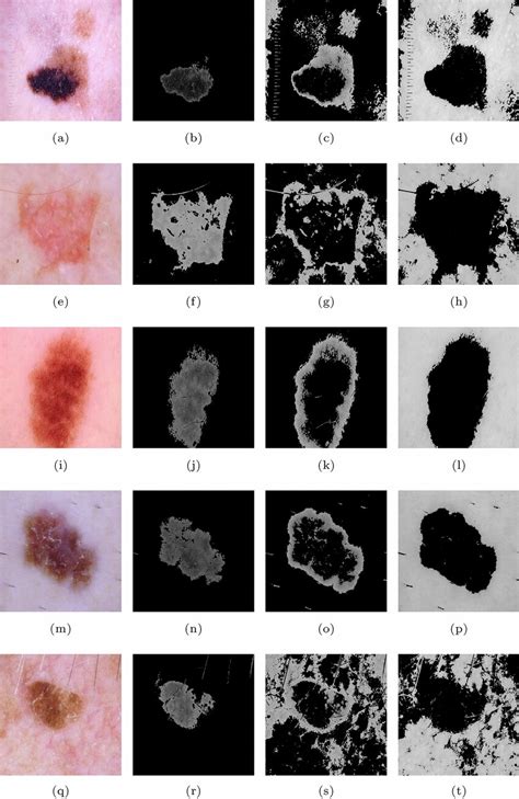segmentation results of proposed algorithm tifcm for isic 0034329
