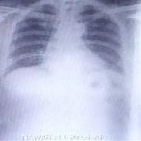 Pneumoniasegmentation Instance Segmentation Dataset By Diplocdm5