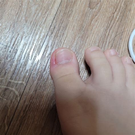 발가락 진물 나오는데 지식in